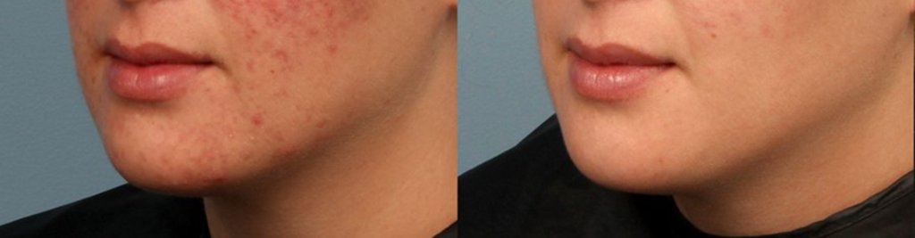 Types of SCAR Treatment - firstscarclinic.pk
